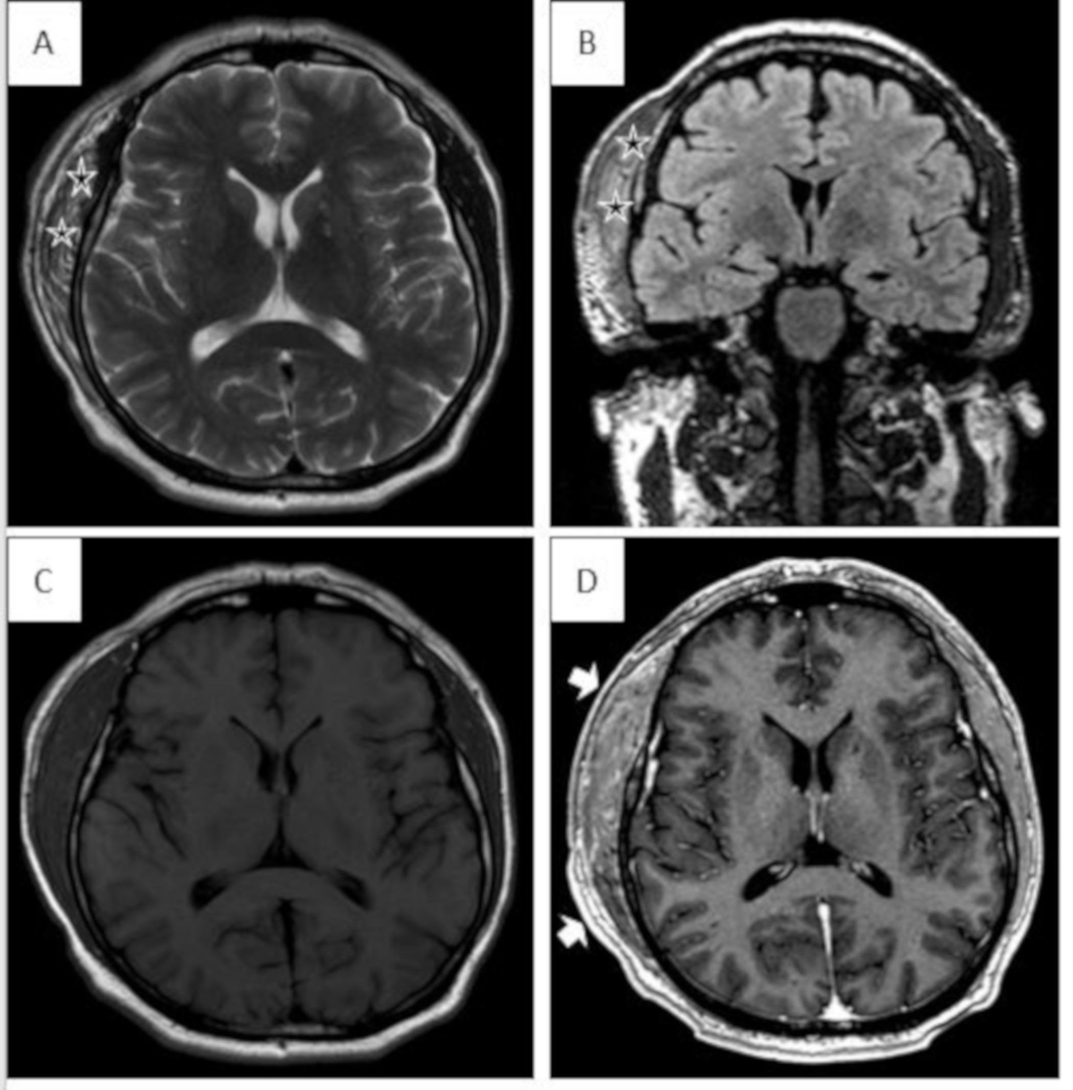 A Rare Cause of Facial Edema and Pain: Temporalis Muscle Hypertrophy