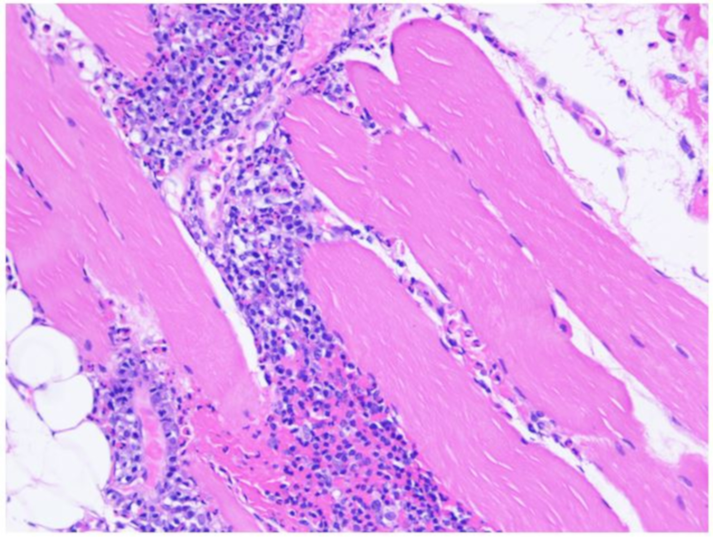 A Rare Cause of Facial Edema and Pain: Temporalis Muscle Hypertrophy